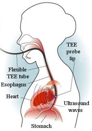 When To Get A TEE for Staphylococcus Aureus Bacteremia – Dr. Germophile