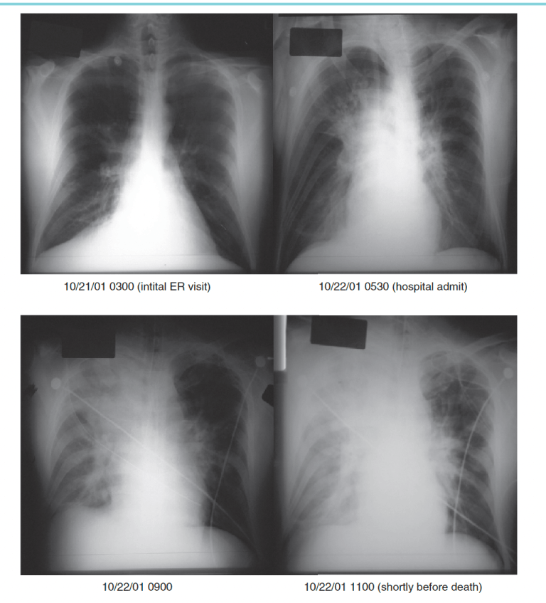 Inhalational Anthrax – The Fulminant Historical Killer – Dr. Germophile